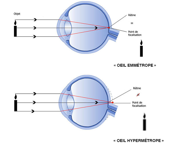Tout Savoir sur l'Hypermétropie : Symptômes, Causes et Solutions ...